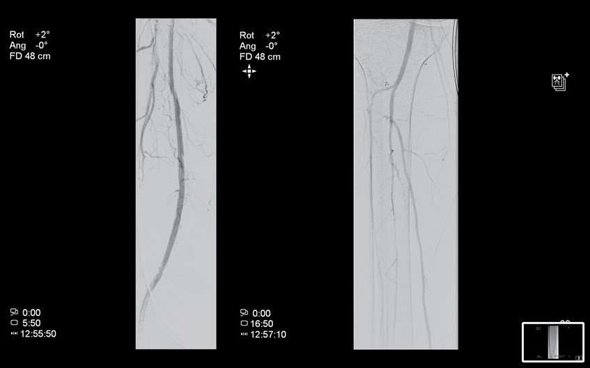 ATERECTOMIA INTRA-STENT COM JETSTREAMSetembro 2020 | ANGIORAD