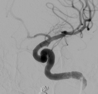 Tratamento endovascular de aneurisma roto do tipo Blister com stent ...