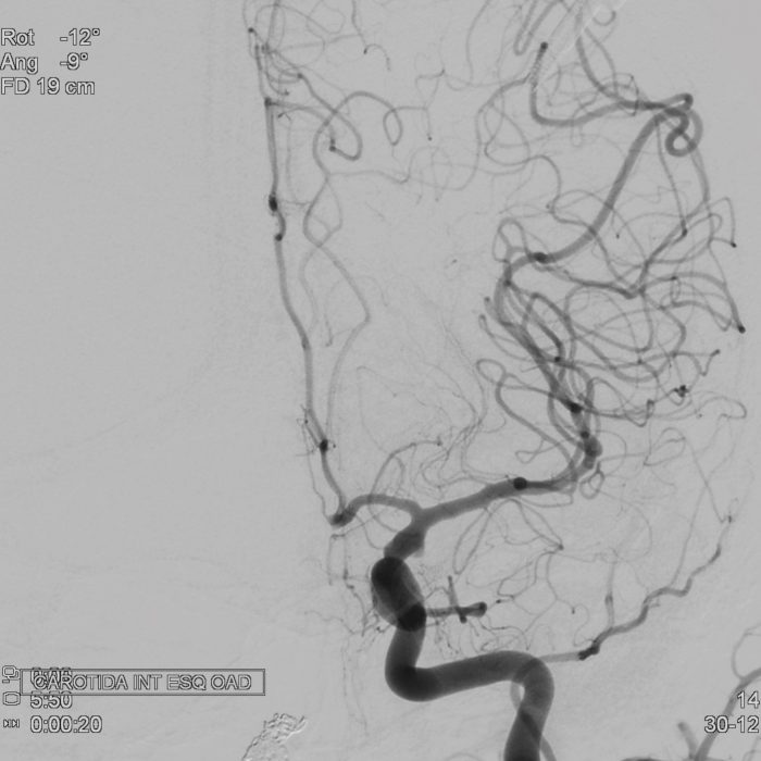 Tratamento endovascular de aneurisma roto do tipo Blister com stent ...