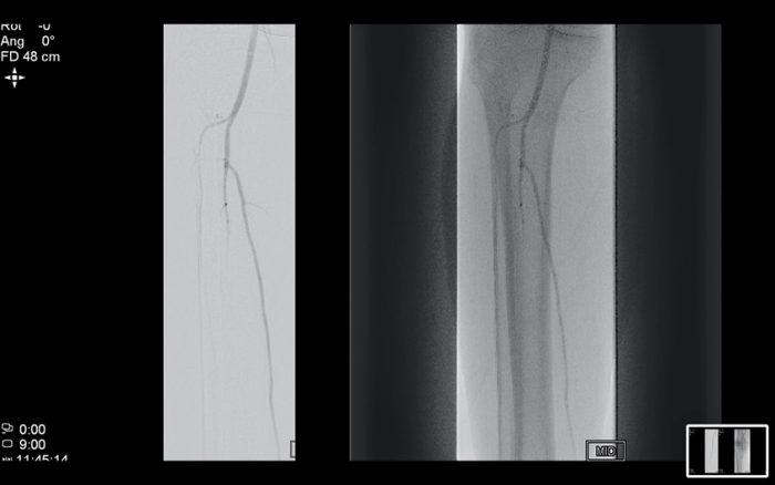ATERECTOMIA INTRA-STENT COM JETSTREAMSetembro 2020 | ANGIORAD
